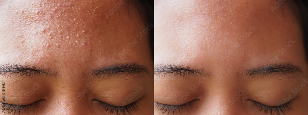Image before and after acne treatment on the face of young Asian woman ...