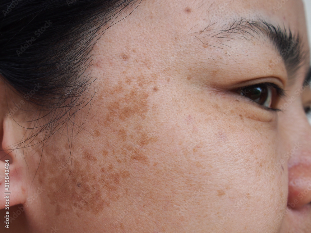 Problem skincare and health concept.Closeup Dark spots melasma freckles ...