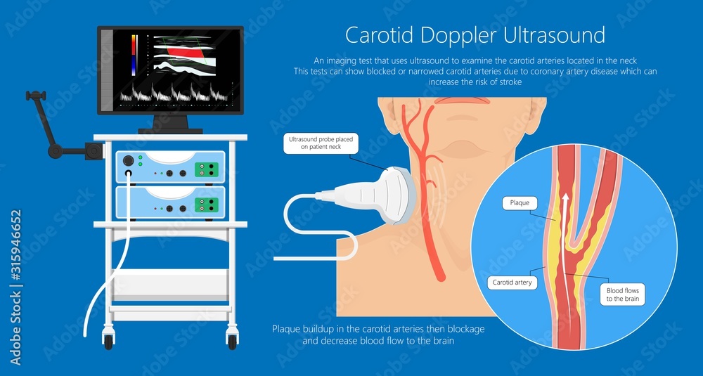 Carotid duplex doppler artery ultrasound disease diagnosis treatment ...