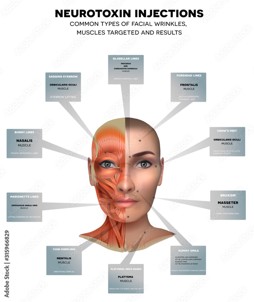 Injections for facial wrinkles. Common types of facial wrinkles ...