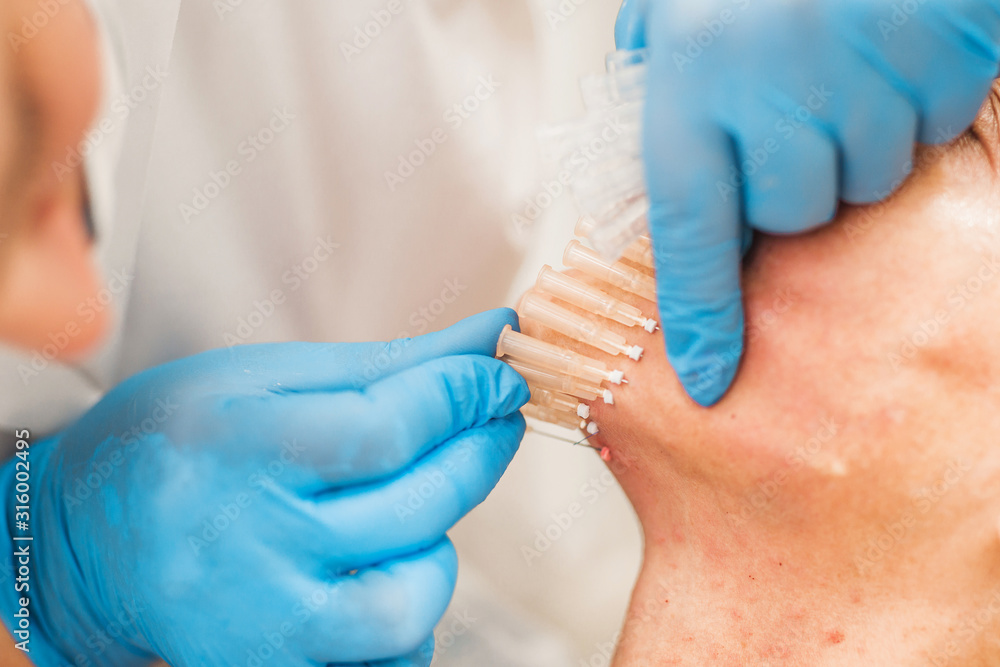 Doctor inserts needles into facial skin for thread lifting - aesthetic ...