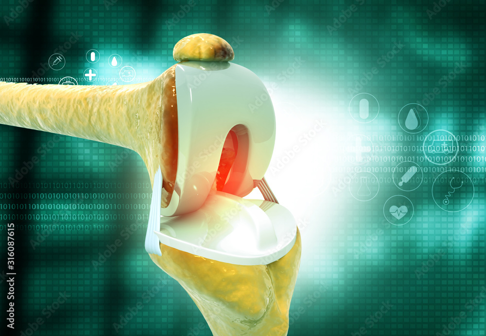 Knee replacement on medical background. 3d illustration. Stock ...