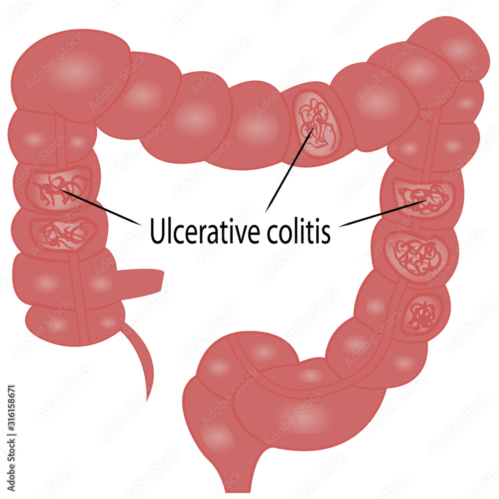 Ulcerative colitis intestine disease vector graphic illustration for ...