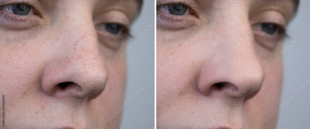 Black dots, clogged pores on the nose of a man close-up. A patient at a ...