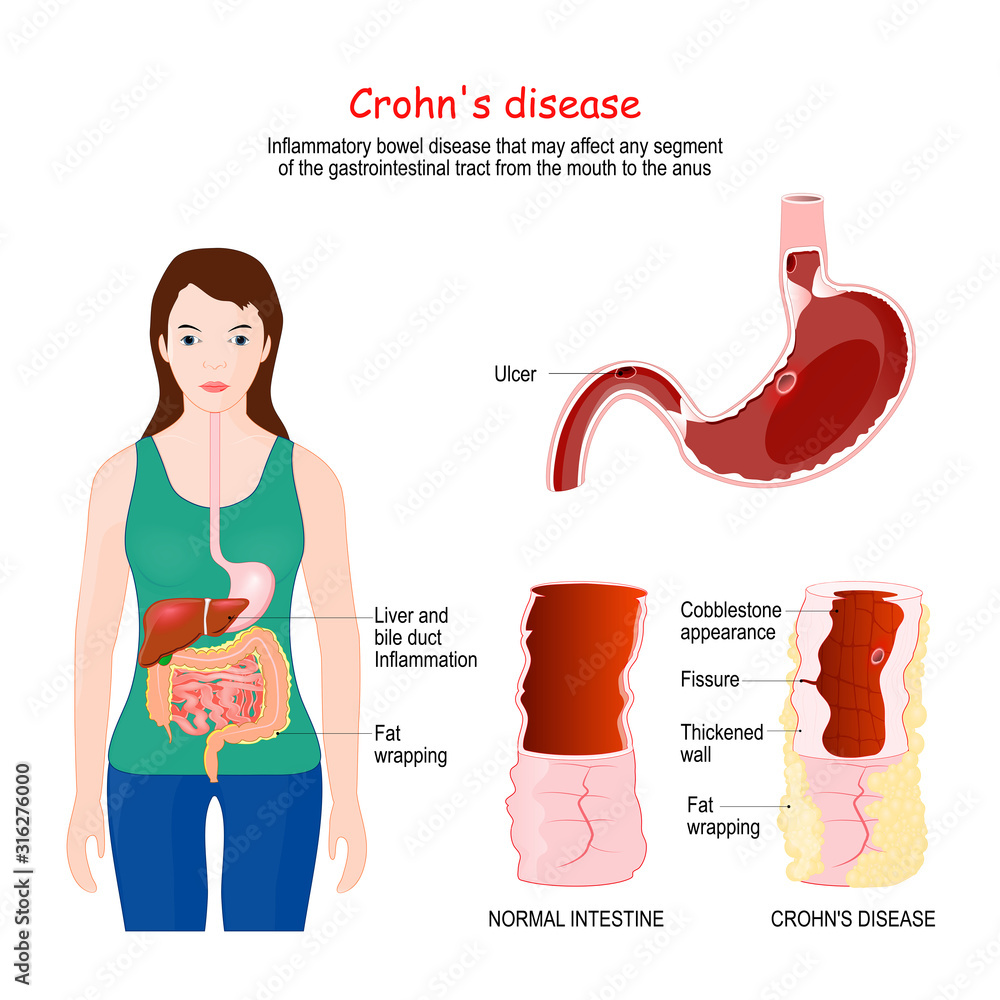 Crohn's disease. Crohn's syndrome. regional enteritis Signs and ...