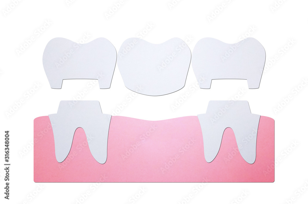 dental crown with bridge, installation process and change of teeth ...