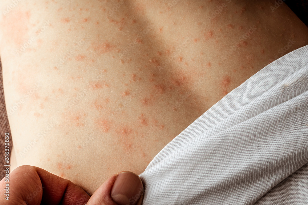 Foto de rash on the child's back. red rash in children of preschool age ...