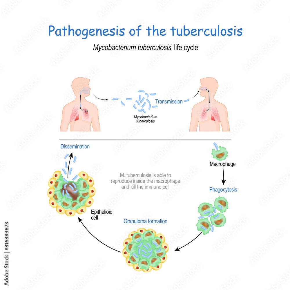Tuberculosis. Life cycle of Mycobacterium tuberculosis. Stock Vector ...