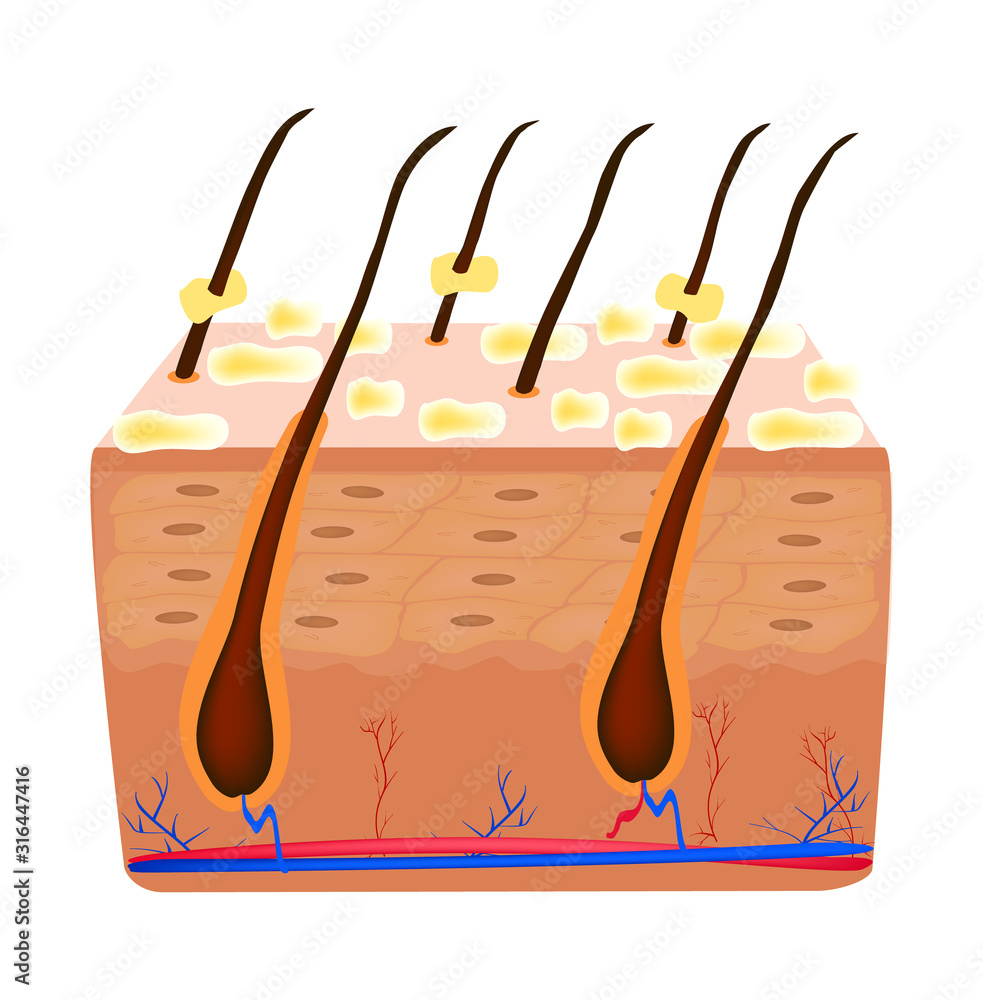Seborrhea skin and hair. Dandruff seborrheic dermatitis. Dysfunction of ...