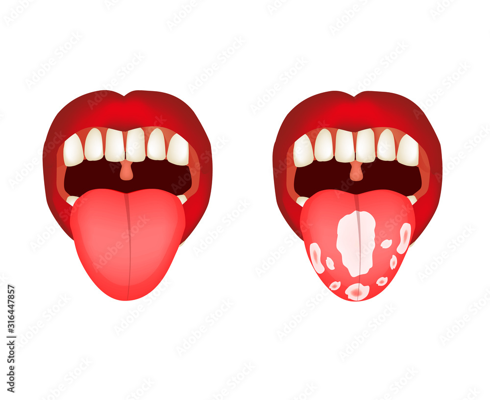 Median Rhomboid Glossitis