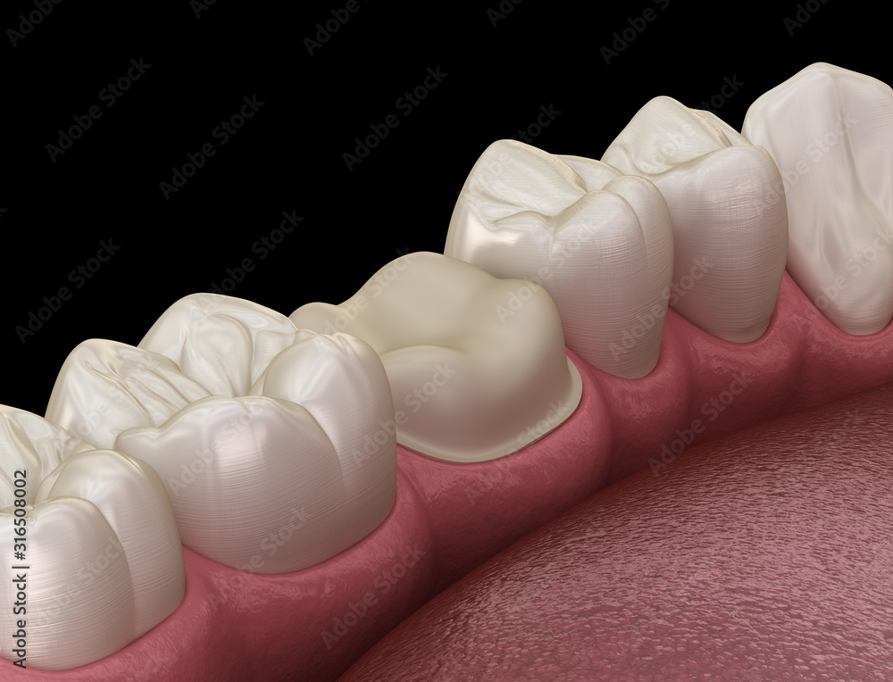 Preparated molar tooth for dental crown placement. Medically accurate ...