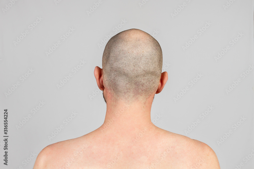 Male alopecia. A man with a bald head. Rear view. Gray background. Copy ...
