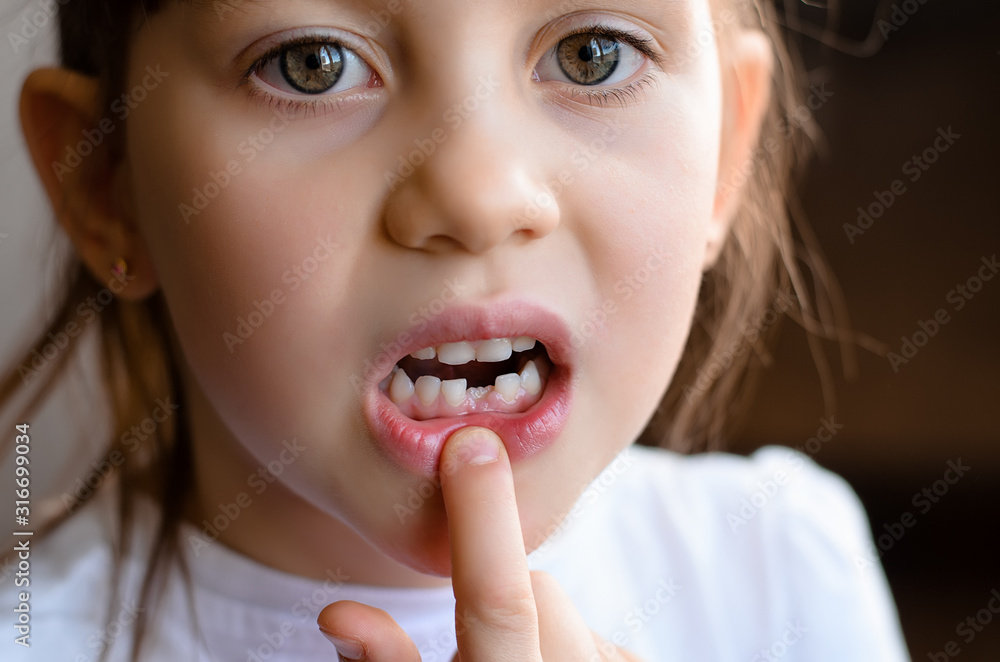 Beautiful smiling preschool girl with her first adult incisor tooth ...