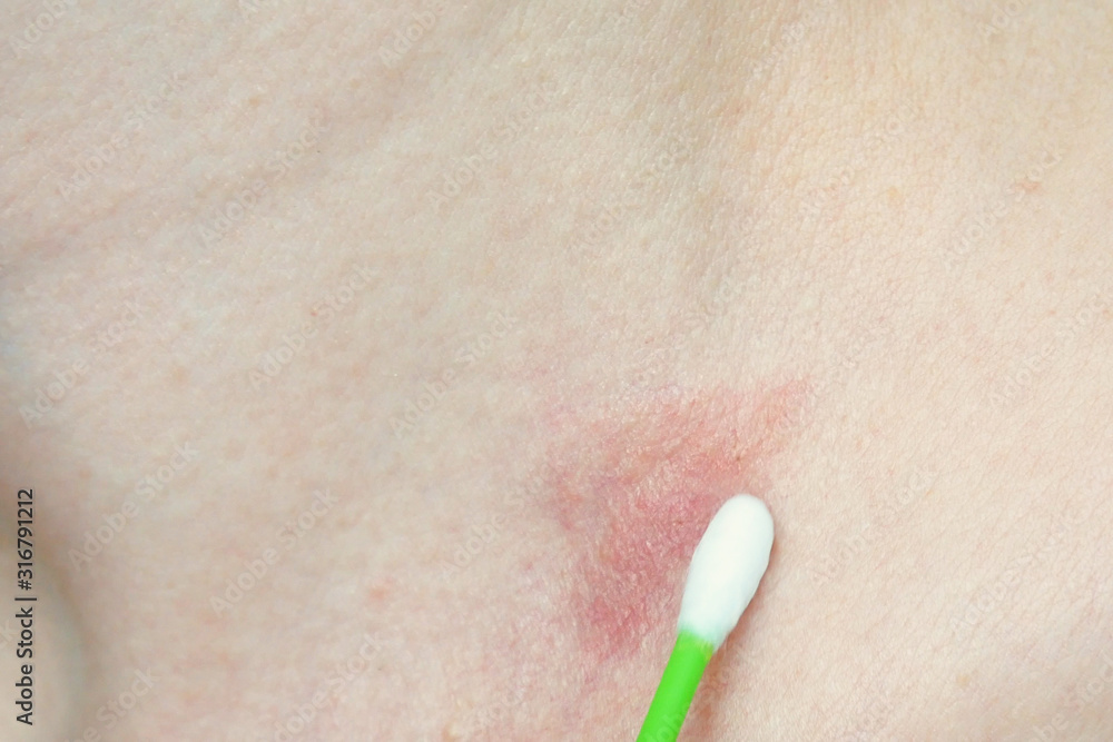 skin rash treatment on woman neck. Shingles, Disease, Herpes zoster ...