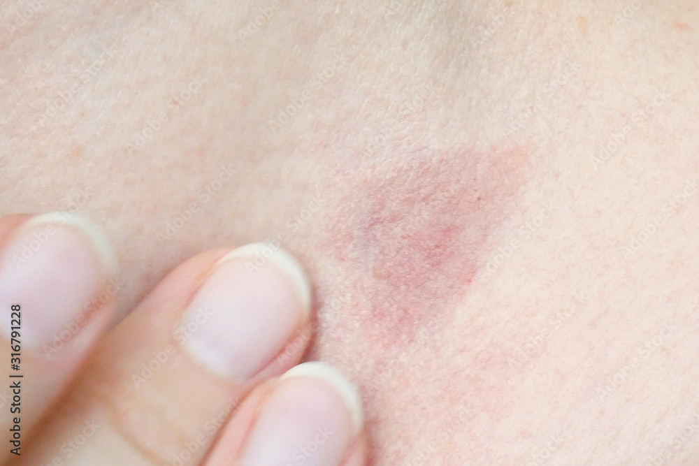 skin rash treatment on woman neck. Shingles, Disease, Herpes zoster ...