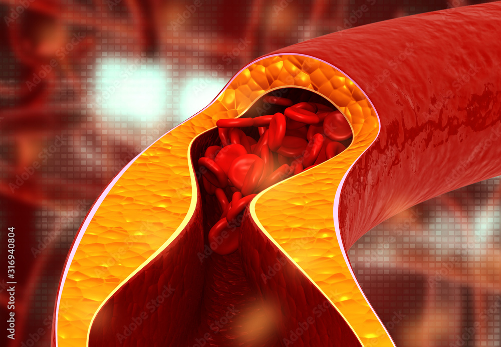 Atherosclerosis, Cholesterol plaque in artery. 3d illustration. Stock ...