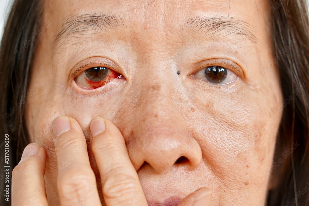 subconjunctival hemorrhage at the right eye Stock Photo | Adobe Stock
