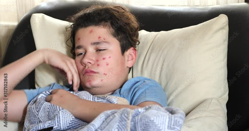 Portrait of a tired young boy suffering from chicken pox rash ...