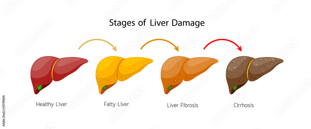 Stages of liver damage. Liver Disease. Healthy, fatty, fibrosis and ...