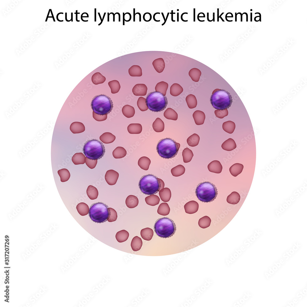 Acute lymphocytic leukemia. Immature lymphocytes. Medical anatomy ...
