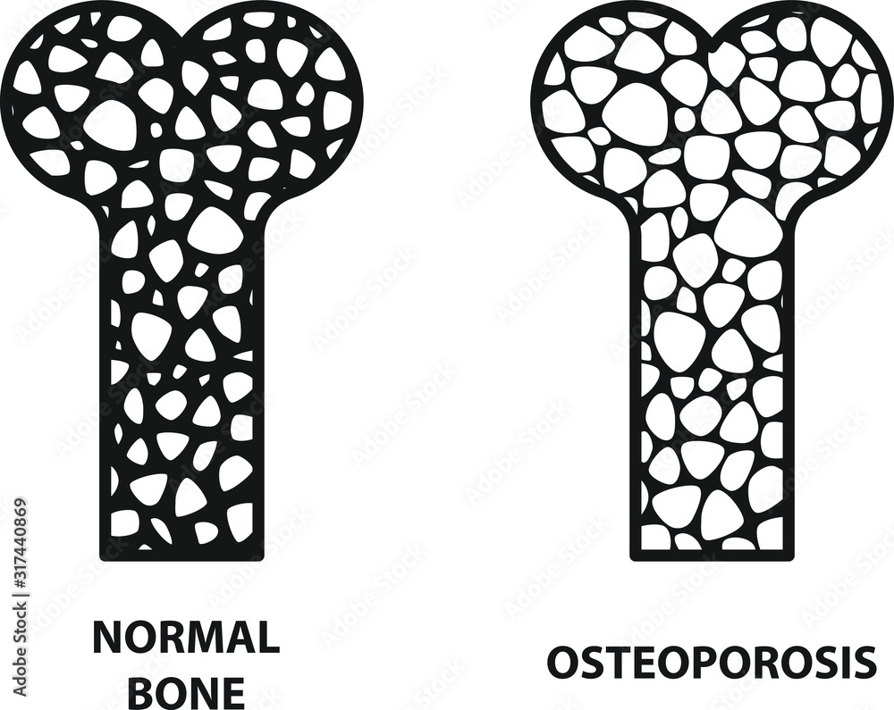 Osteoporosis icon ,Bone structure, vector illustration Stock Vector ...