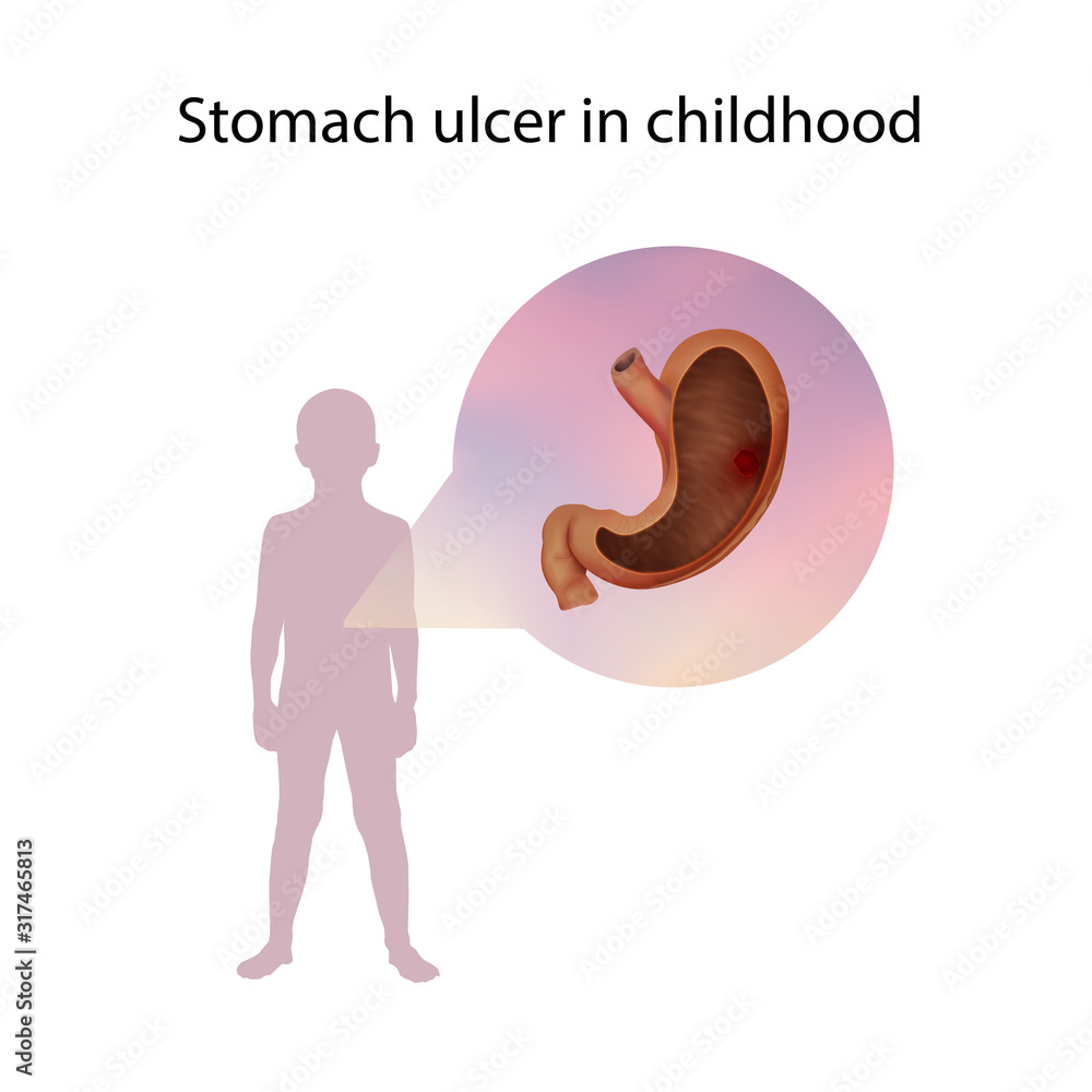 Stomach ulcer in childhood. Medical anatomy illustration. Stock ...