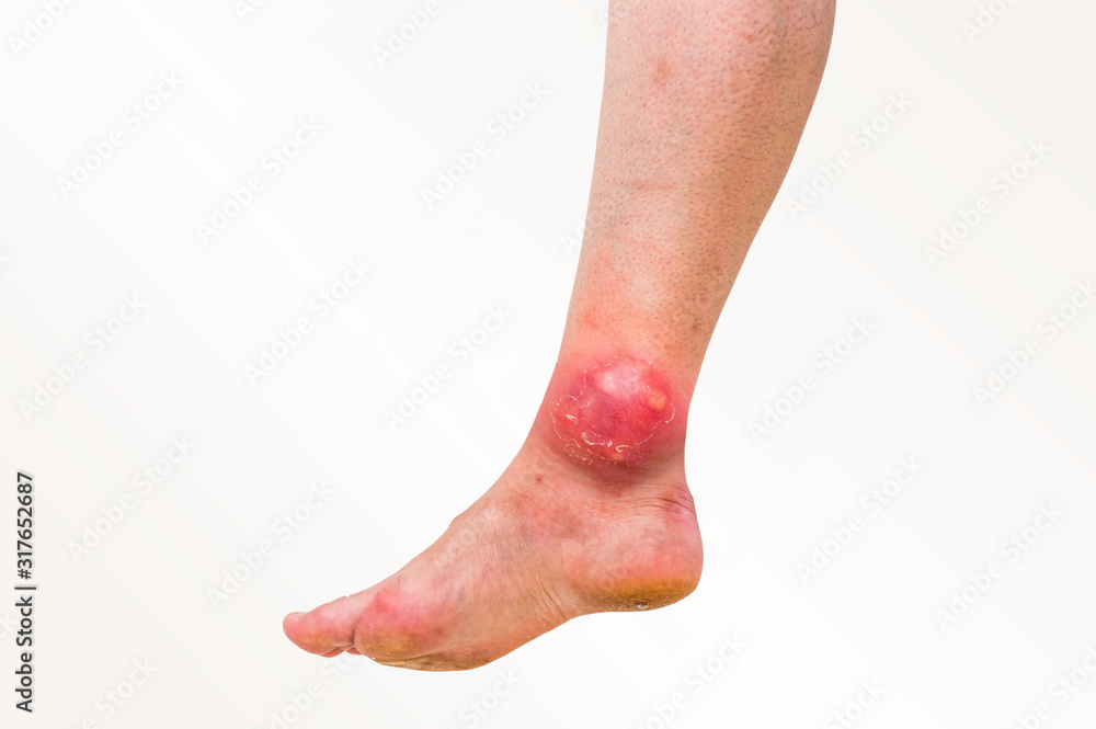 Red rash on leg of patient who was bitten by an insect Stock Photo ...