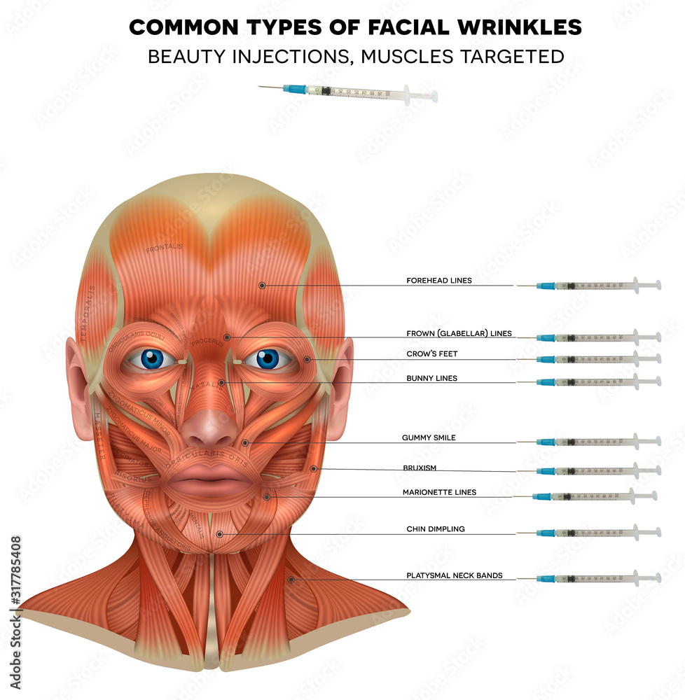 Common types of facial wrinkles treatment Stock Vector | Adobe Stock