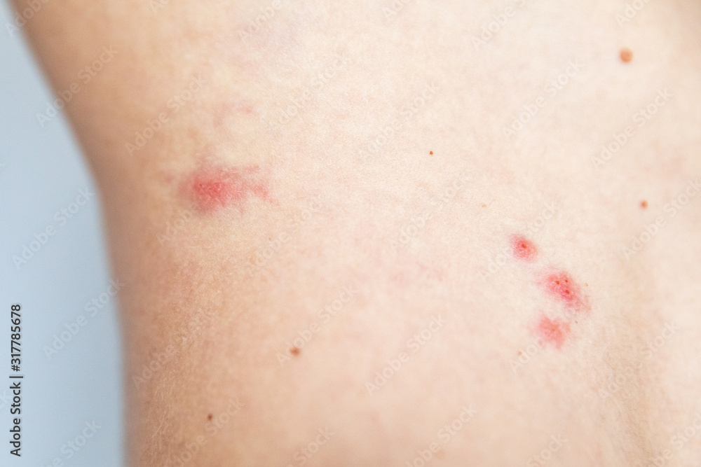 Herpes on body. Skin disease. Professional doctor examining skin of a ...