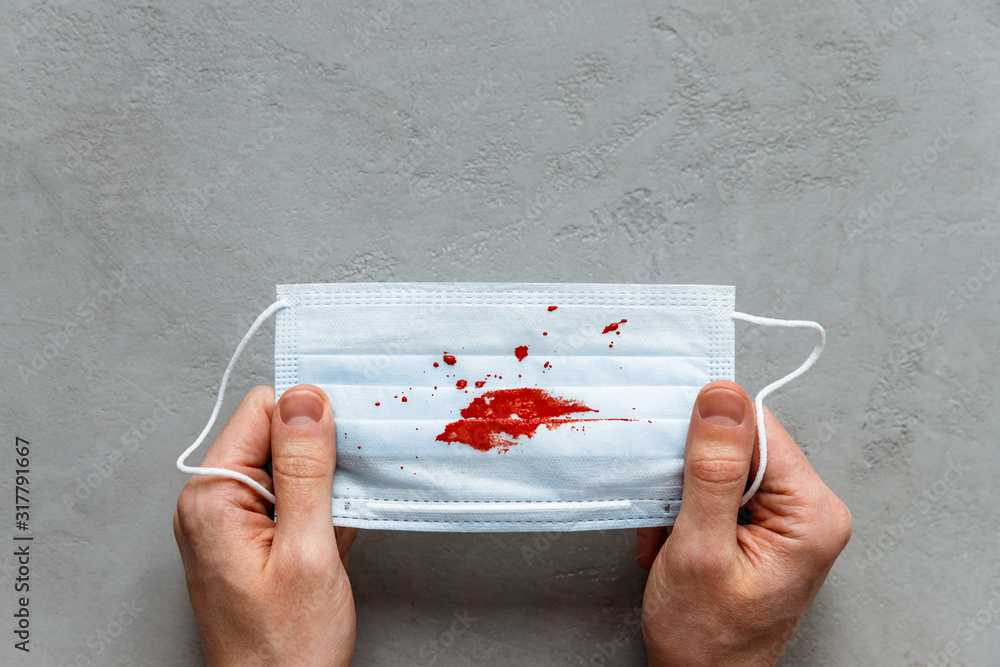 Lung cancer, tuberculosis, viral bronchitis symptoms. Hemoptysis from ...