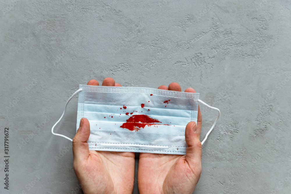 Lung cancer, tuberculosis, viral bronchitis symptoms. Hemoptysis from ...