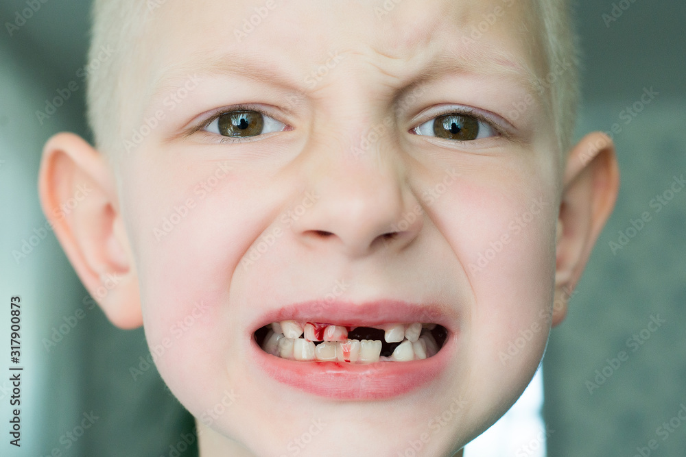 the boy staggers a milk tooth and runs blood, soon the tooth will fall ...