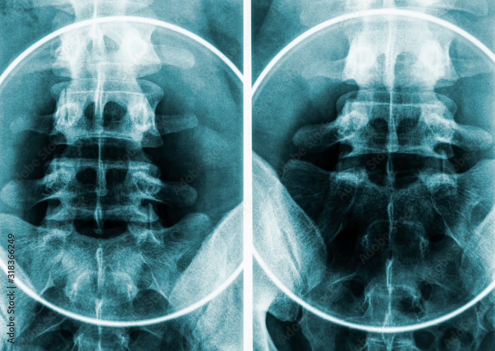 X-ray imagery or radiography of human male pelvis and lumbar vertebrae ...