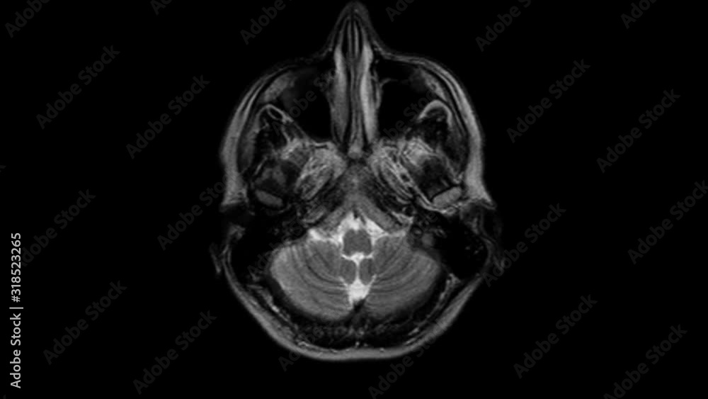 Brain MRI, head scans and tumor detection. Diagnostic medical tool ...