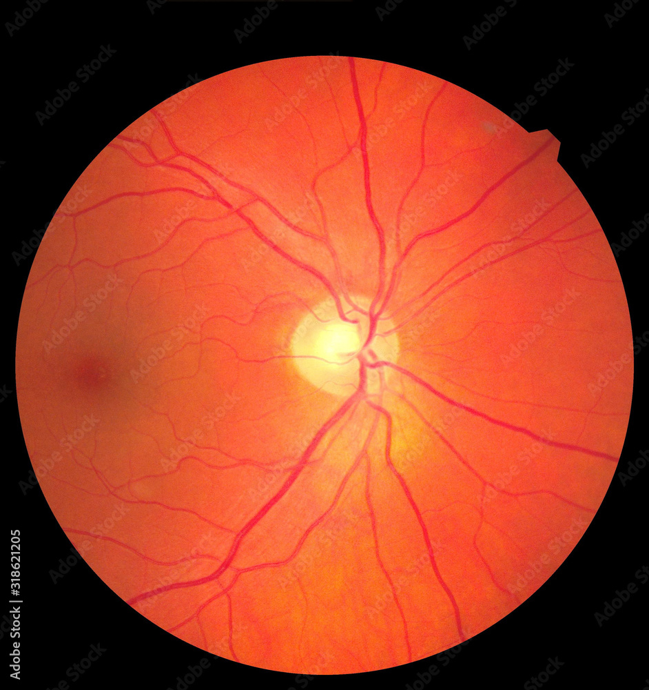Stockfoto View inside human eye disorders showing retina, optic nerve ...