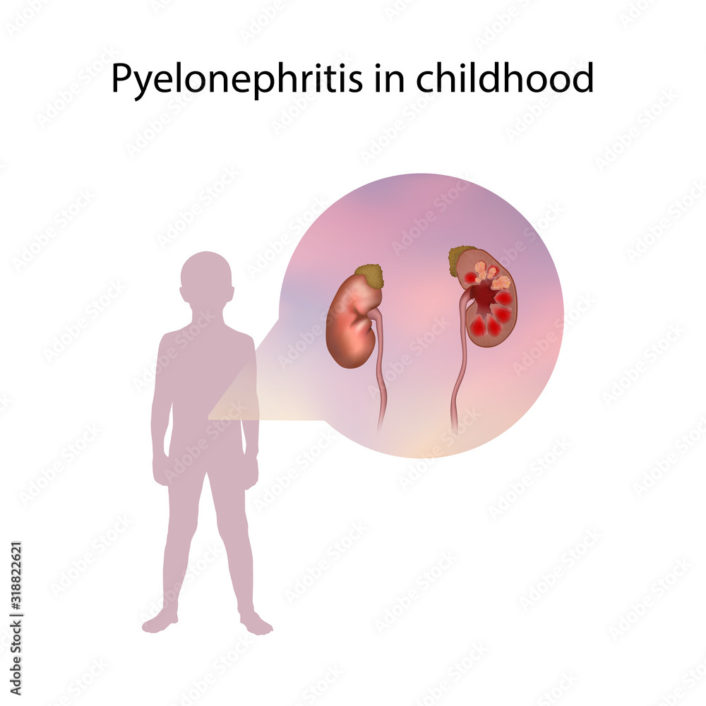 Pyelonephritis in childhood. Kidney infection. Medical anatomy ...