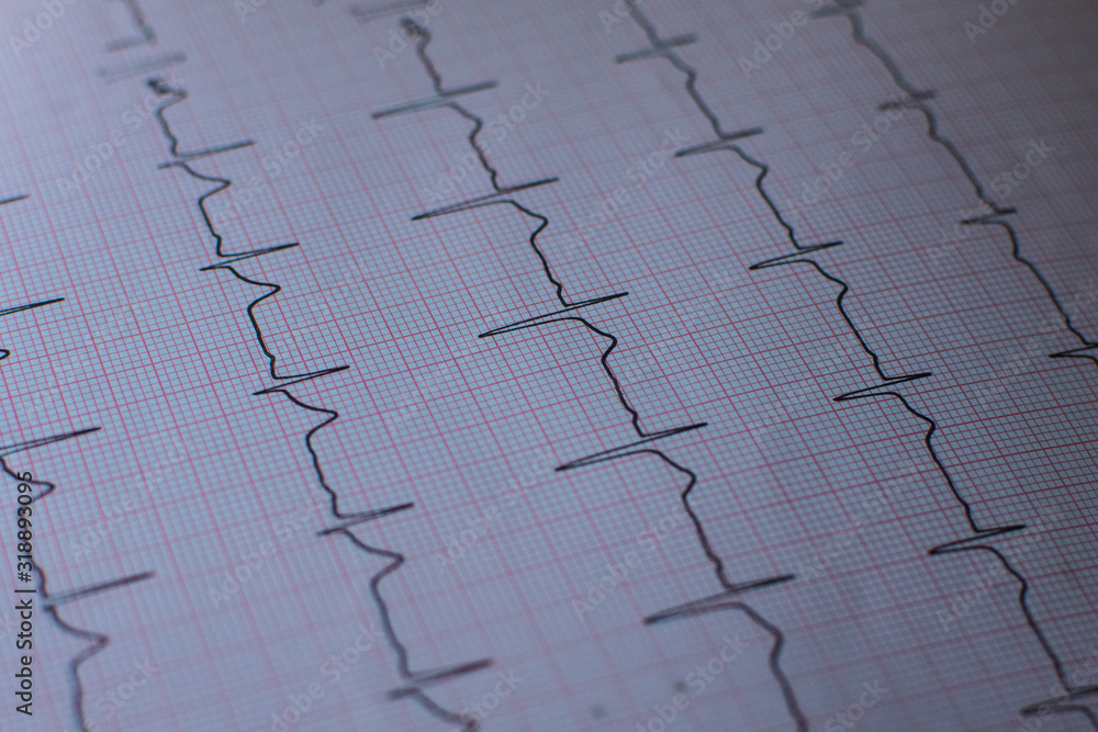 Cardiogram (ECG), heart rhythm on the special paper close up Stock ...