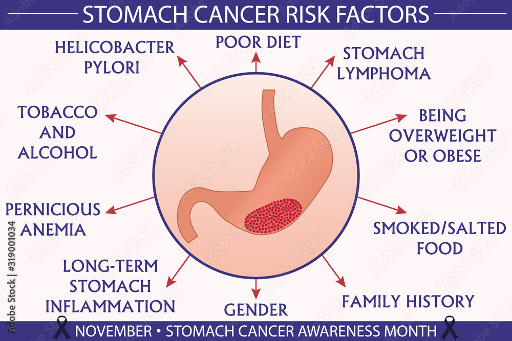 Stomach Cancer Risk Factor Infographic Vector Illustration Health And