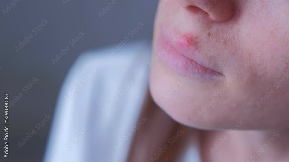Video Stock Herpes virus on human lips. Woman with herpes sore on lip ...