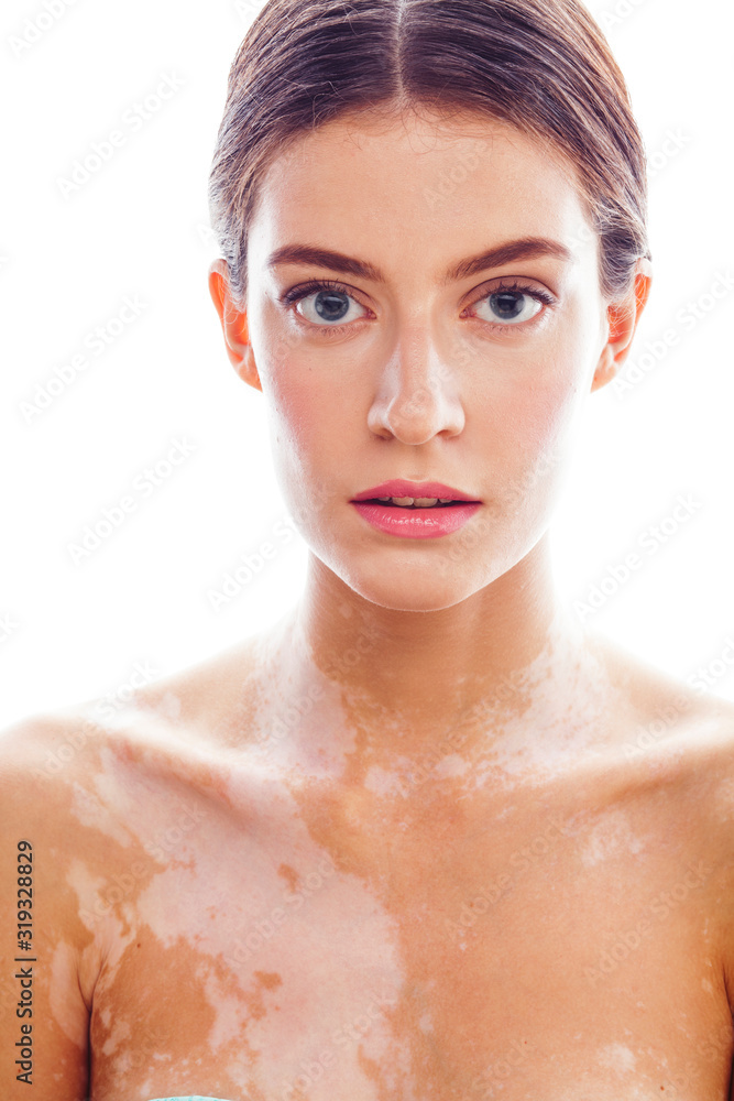 beautiful young brunette woman with vitiligo disease isolated on white ...
