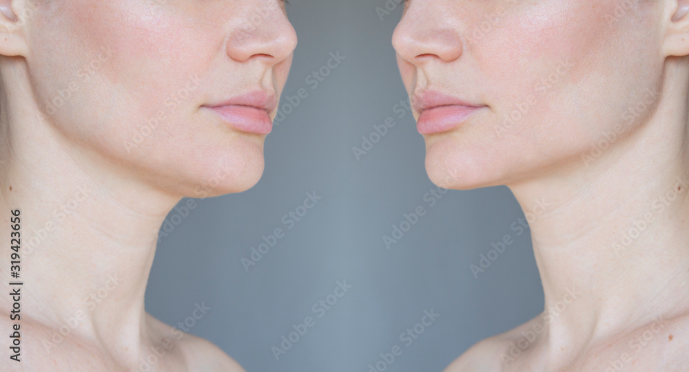 plastic of the lower third of the face, sagging chin Stock Photo ...