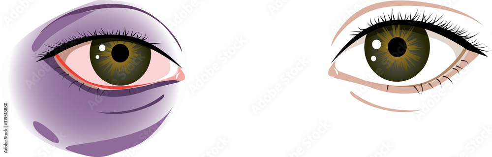 Human eyes, one of them bruised, EPS 8 vector illustration, no ...