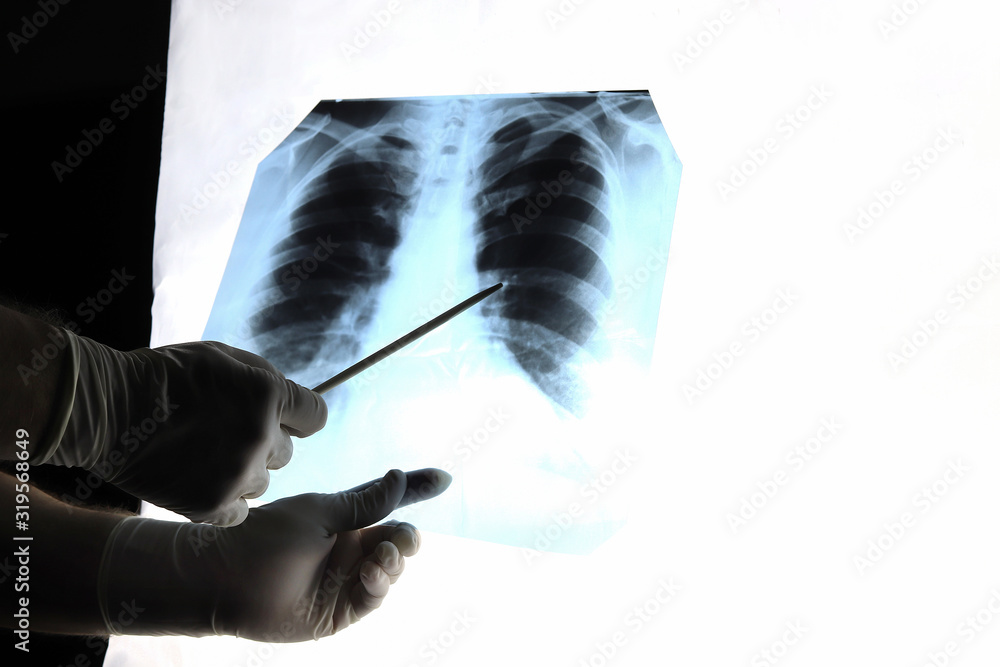 Hands of a doctor and an x-ray of the lungs, chest of a patient with ...