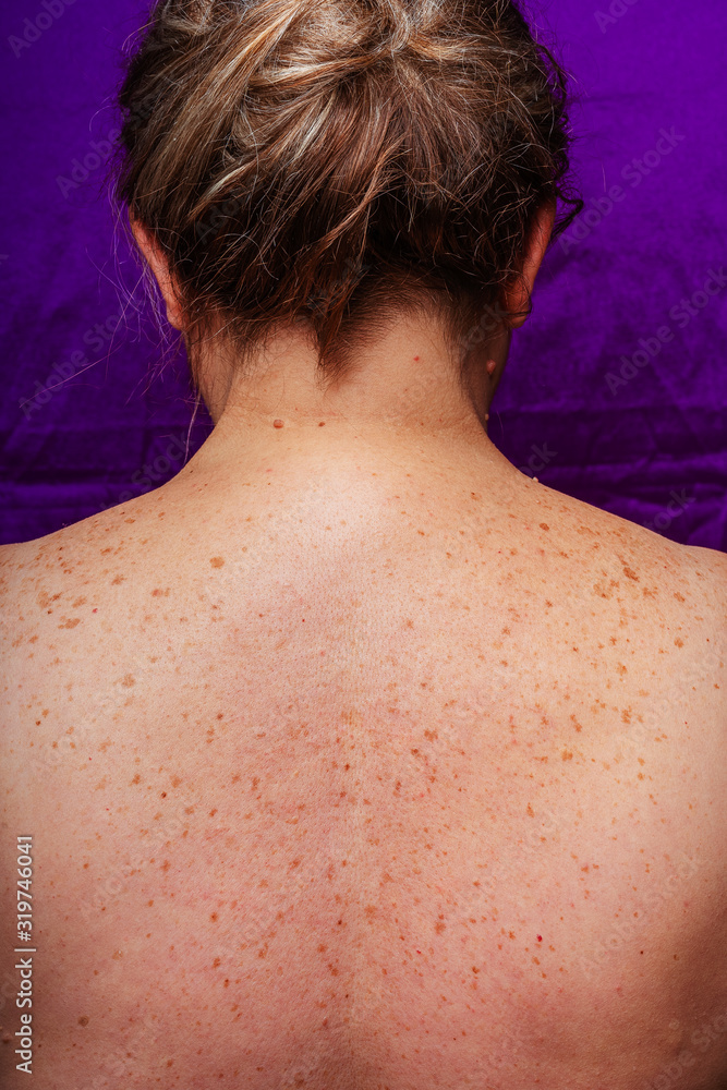 Age spots, moles, and freckles on the back of an older woman ...