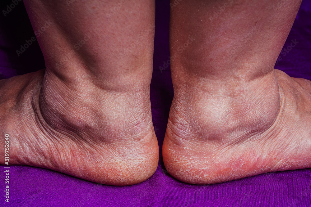 Skin allergic dermatitis redness on the foot. Old woman's legs. Cracks ...