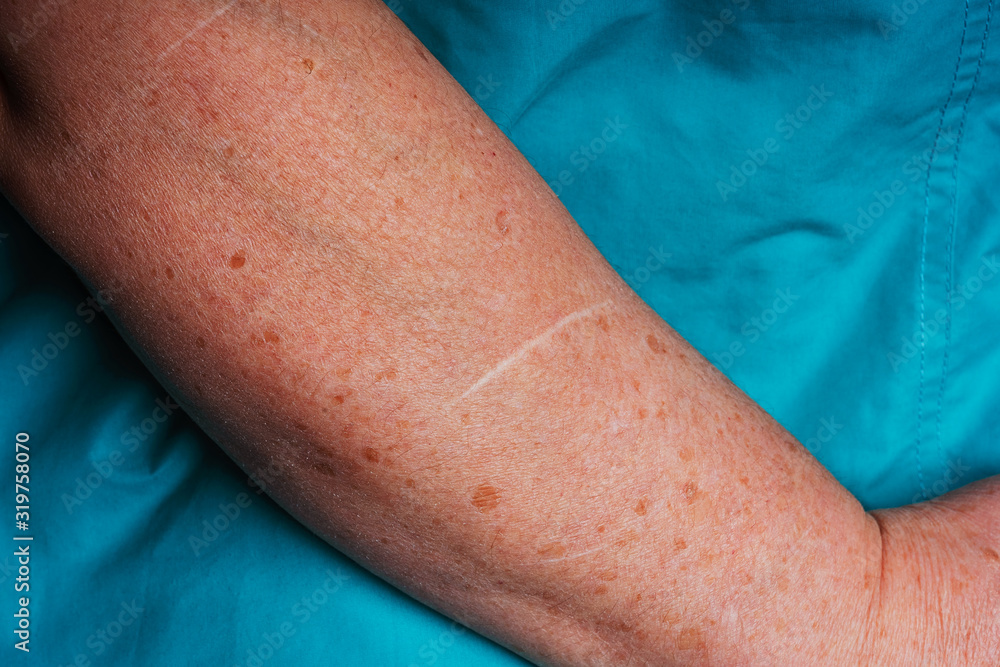 Old scars on an elderly woman's body. Scars and marks from a car crash ...
