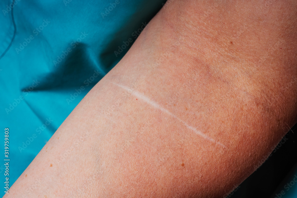Old scars on an elderly woman's body. Scars and marks from a car crash ...