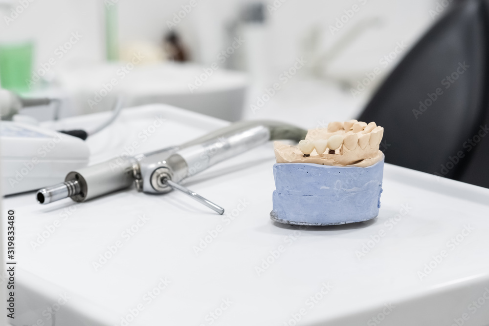 Dental prosthetics on implants, artificial jaw with dentures on the ...