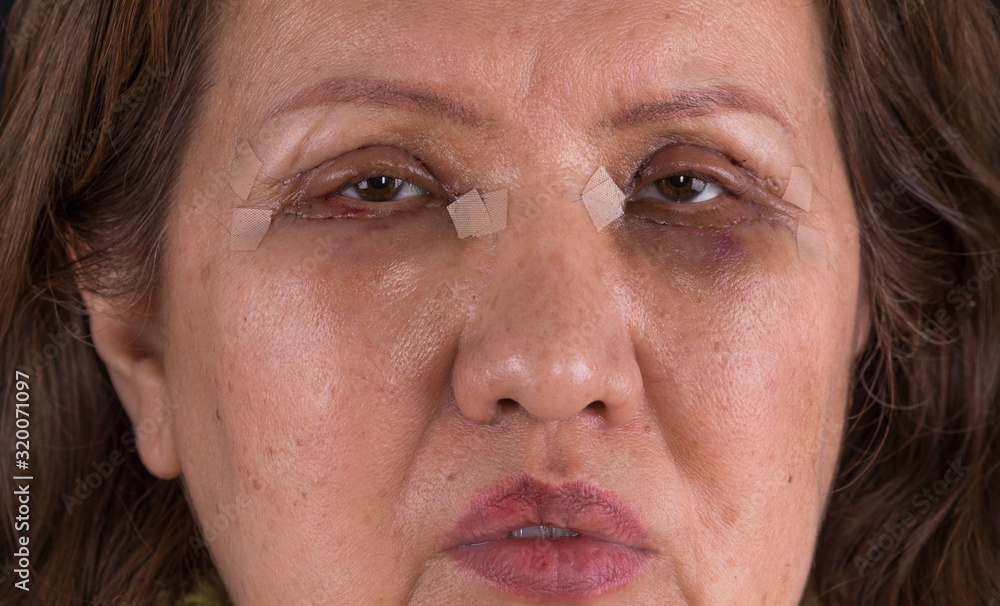 Eyes of an old woman after plastic surgery,blepharoplasty,eye bag ...