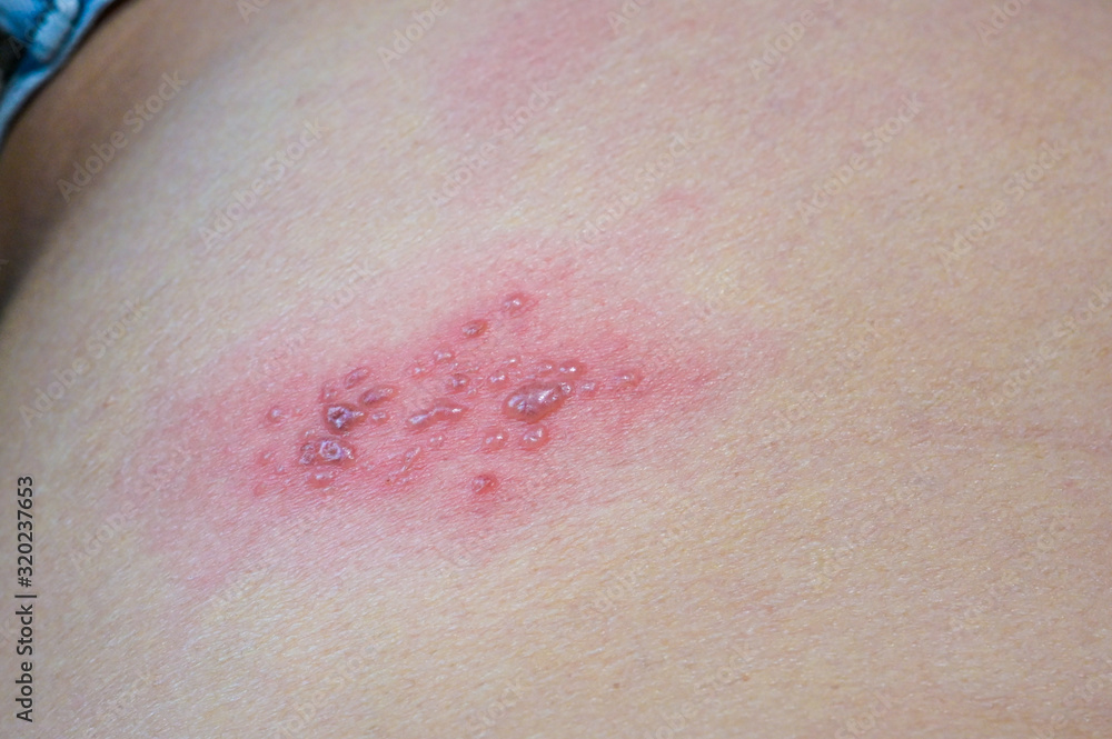 blisters caused by shingles on skin, herpes zoster Stock Photo | Adobe ...